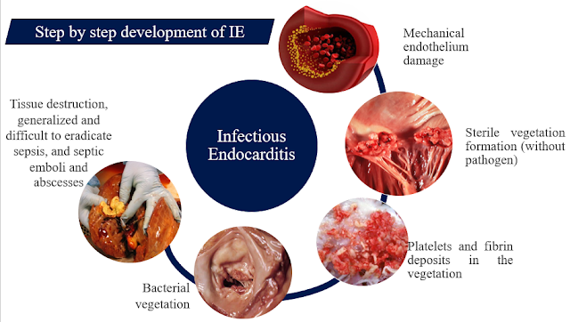 Infectious endocarditis (IE)