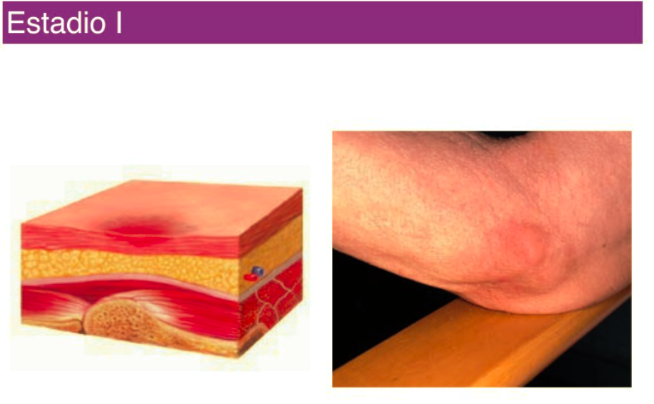 3. PREVENCIÓN Y TRATAMIENTO DE LAS ÚLCERAS POR PRESIÓN