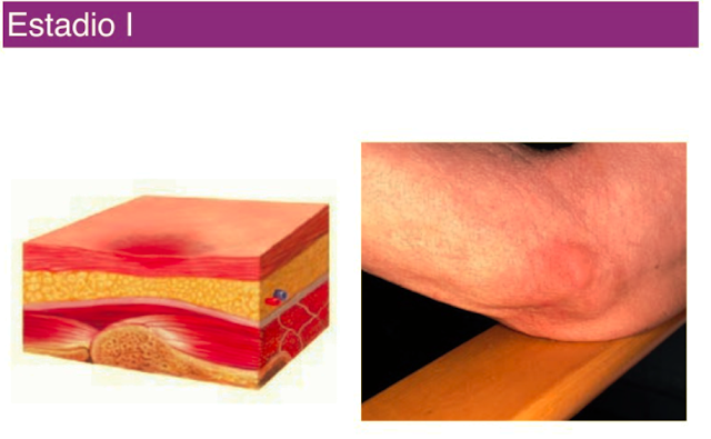 3. PREVENCIÓN Y TRATAMIENTO DE LAS ÚLCERAS POR PRESIÓN