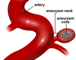 The modern Endovascular Coiling is the safest method to treat Aneurysm!