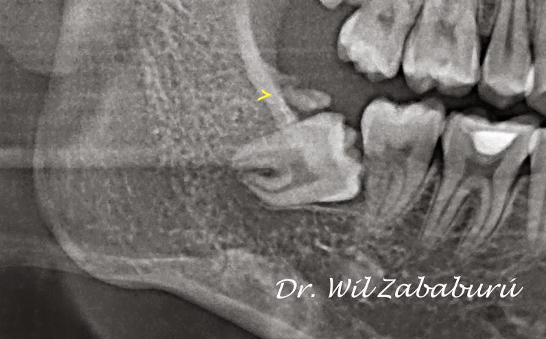 CLINICA DENTAL ASISTENCIAL: DISTOMOLAR