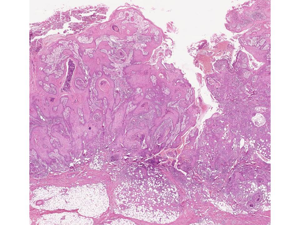 Dermpath Made Simple - Neoplastic: Squamous cell Carcinoma