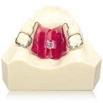 Open Lab UPC Ortodoncia 2012 : APARATO DE HASS