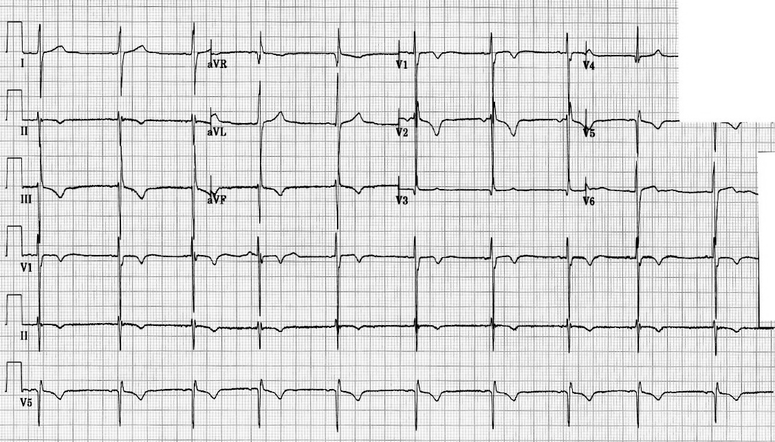 ECG of the Week: ECG of the Week - 24th September 2018 - Interpretation