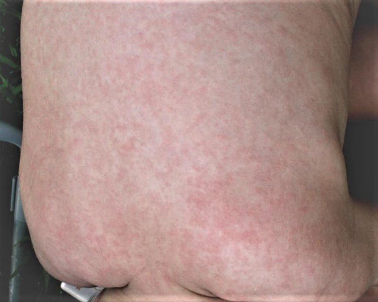 Grafico De Exantema Viral Epidemiología – Hospital Del Niño Dr.