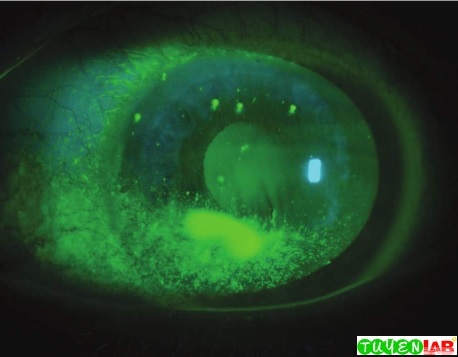 [Emergency] Atlas of Corneal Abrasion | Free Medical Atlas