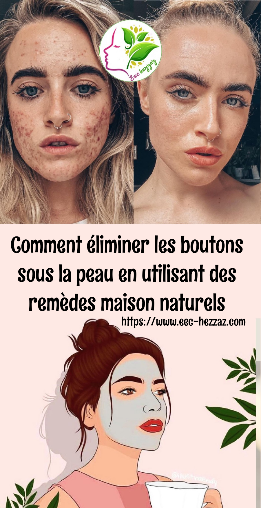 Comment éliminer les boutons sous la peau en utilisant des remèdes ...