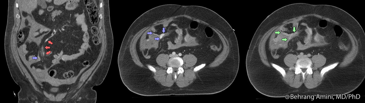 Roentgen Ray Reader: Mesenteric Trauma