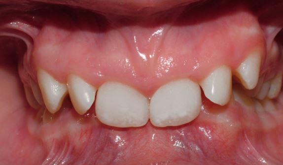 Causes of Open bite, Deep bite, crowding, Generalized spacing, Midline ...