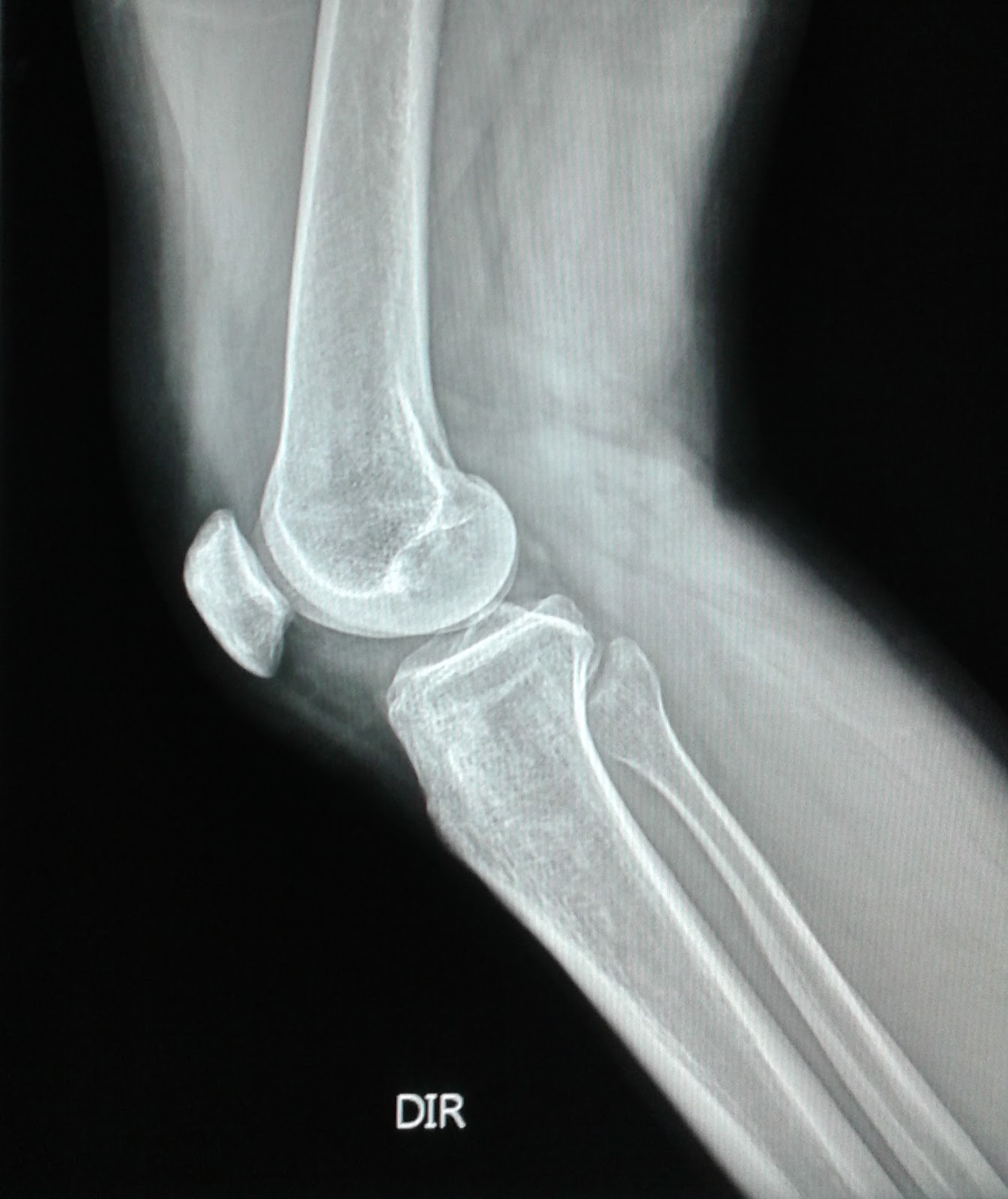 Posicionamento radiológico do Joelho - Rosydays