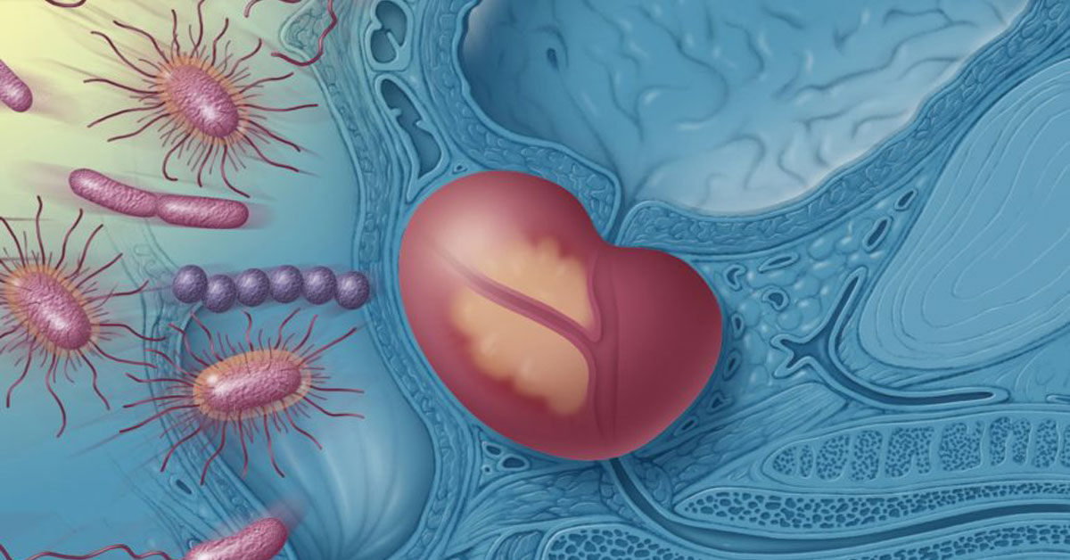 ΠΡΟΣΤΑΤΙΤΙΔΑ: Η φλεγμονή του προστάτη - ΒΟΤΑΝΟ