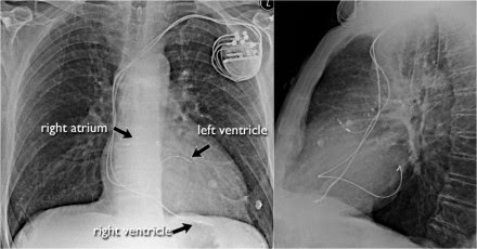 Chest Medicine Made Easy-Dr Deepu: BASICS OF CHEST X RAY-PART 4, THE ...