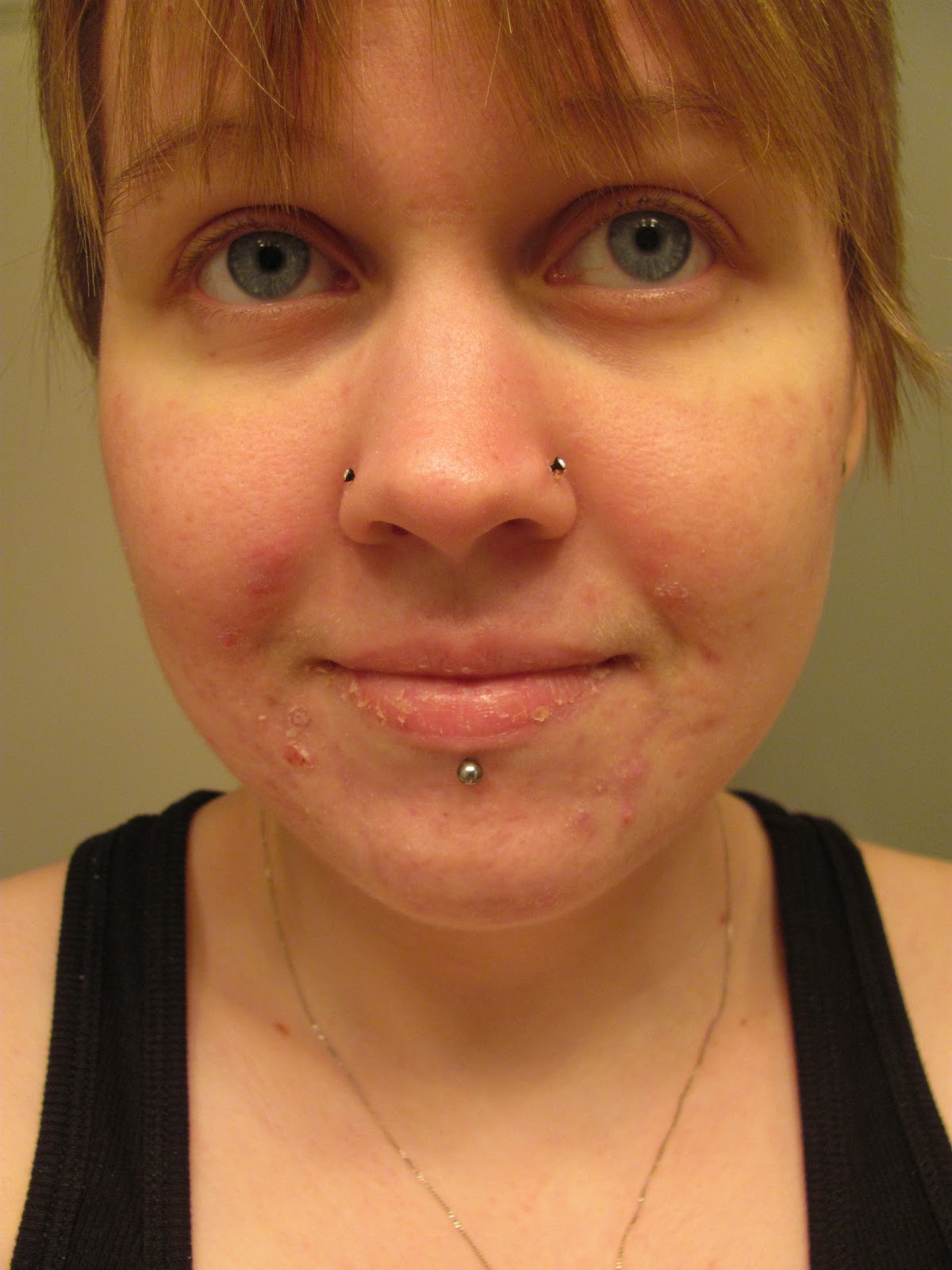 Writings and Rants: The First Month of Accutane In Pictures