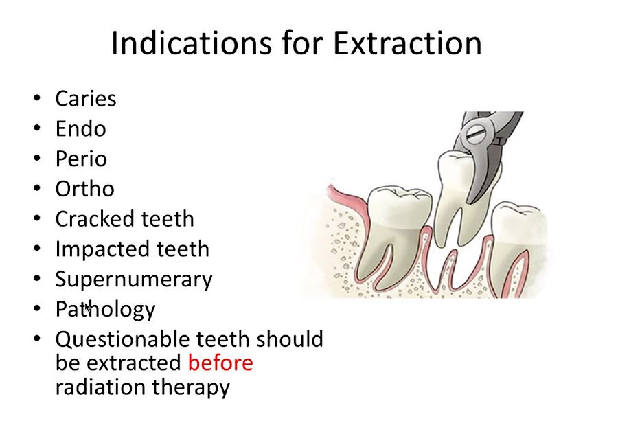 ORAL SURGERY: Impaction & Extraction Facts - Odonto-Tv