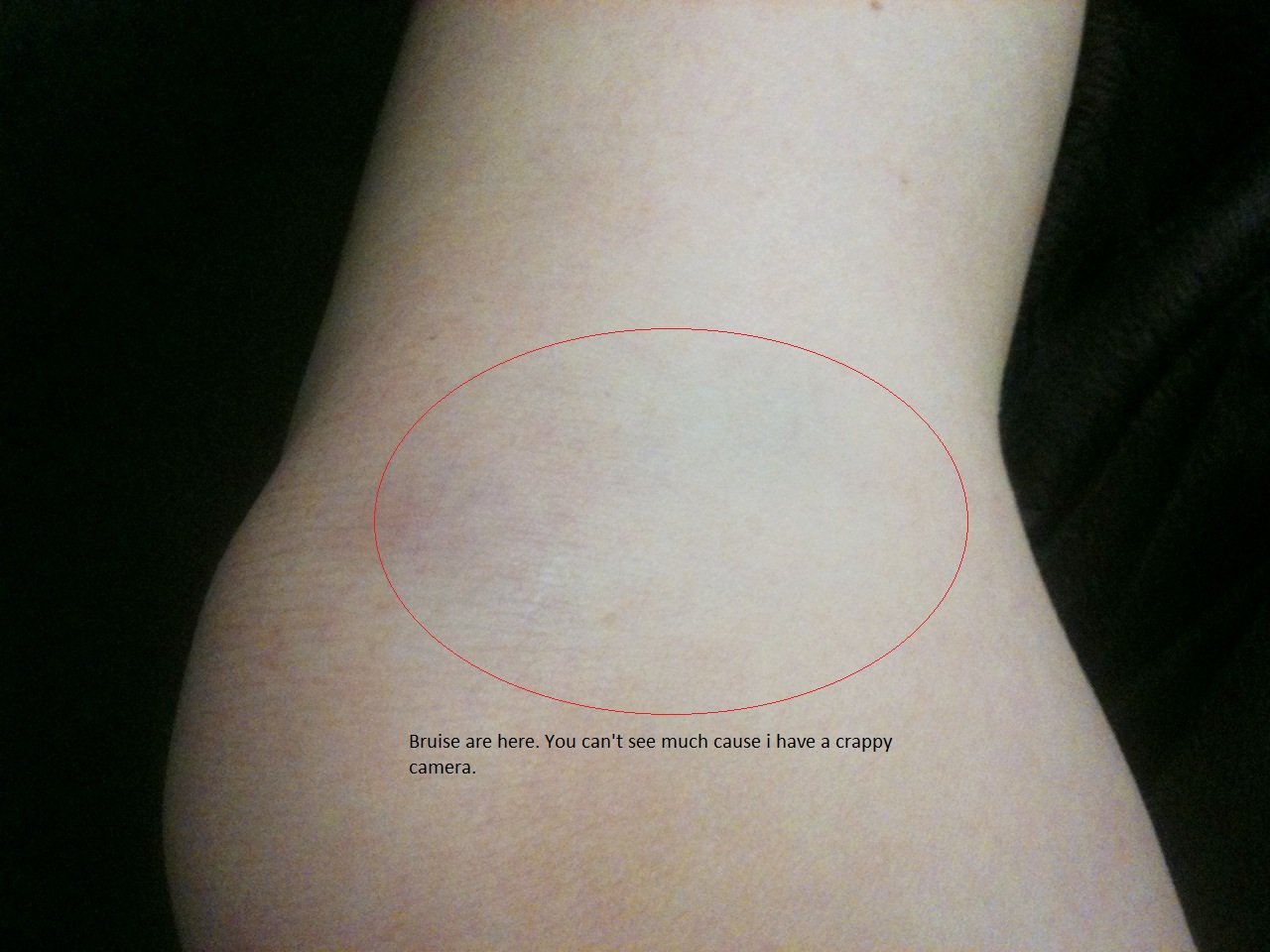 oh mah goodness: Day one of bruise progression.