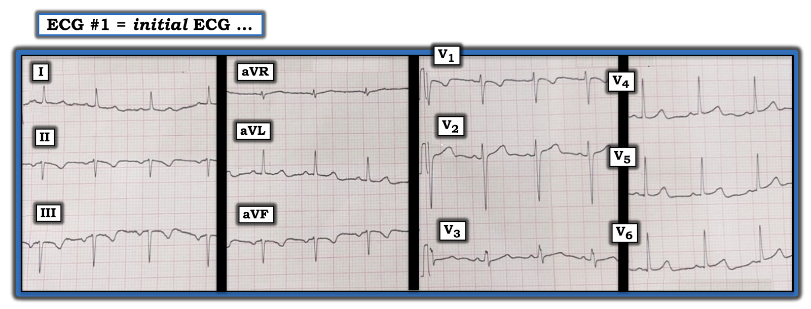 Dr. Smith's ECG Blog: July 2020