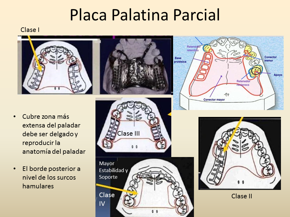 REHABILITACION II : 2° Parcial Conectores Mayores