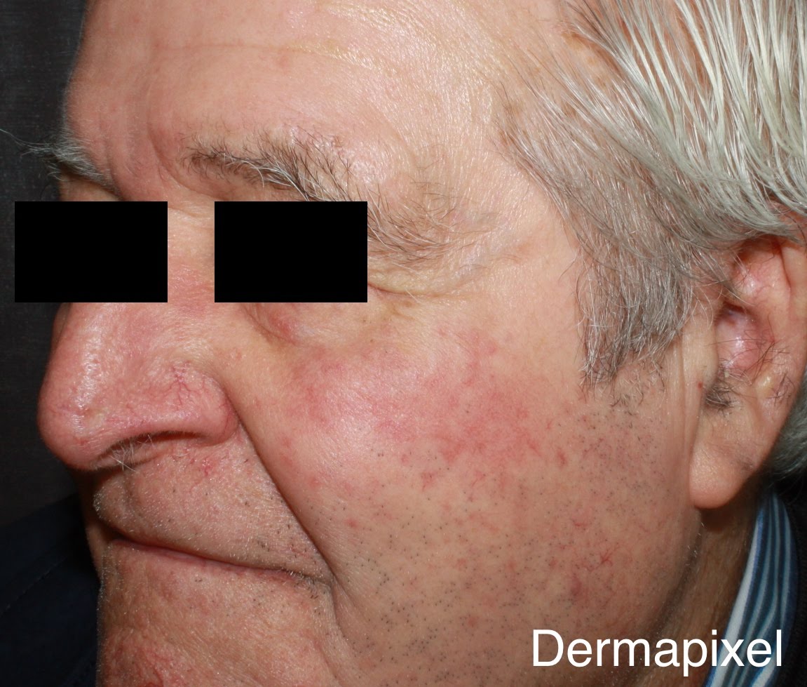 Dermapixel: marzo 2018