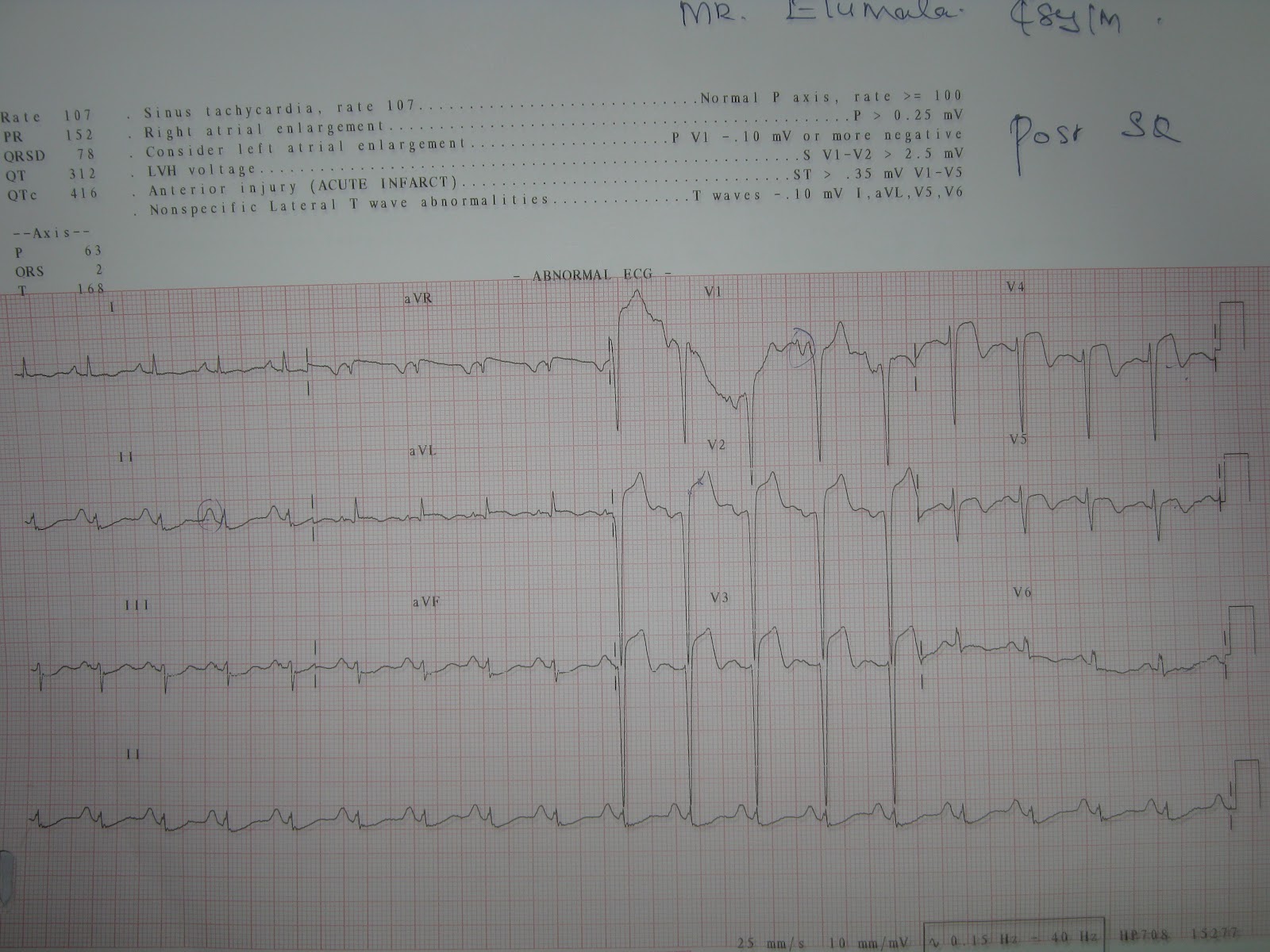 Medical Images Gallery: Anterior Wall MI ECG : ECG changes before and ...