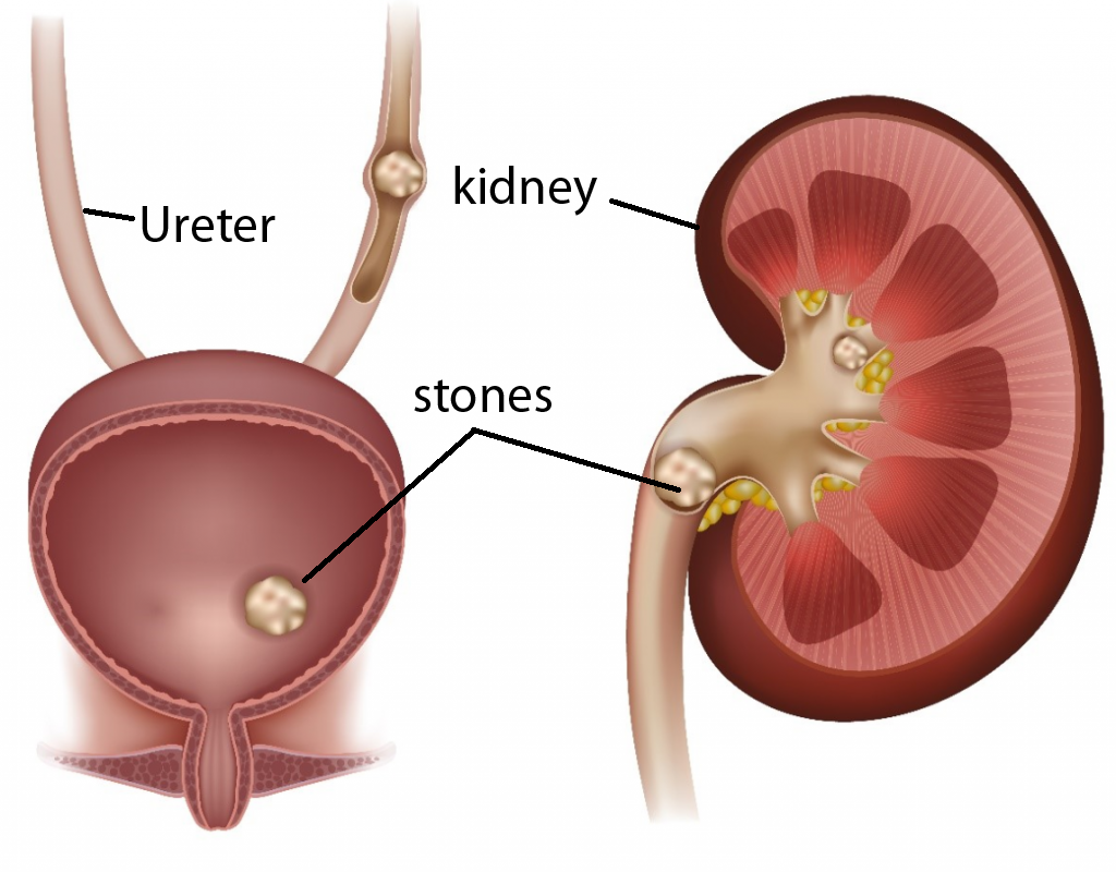 Kidney Stone Symptoms Risk Factors Types Causes Health Fitness kidney-stone-symptoms-risk-factors-types-causes-health-fitness