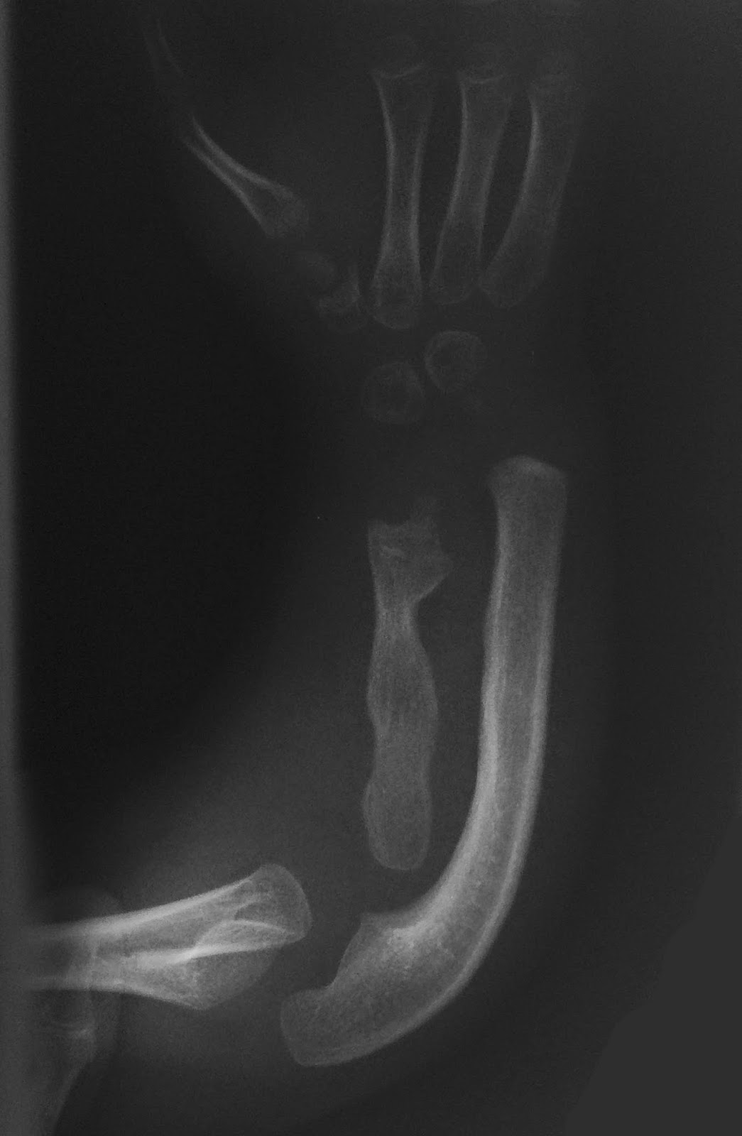 Type 2 Radial Longitudinal Deficiency | Congenital Hand and Arm ...
