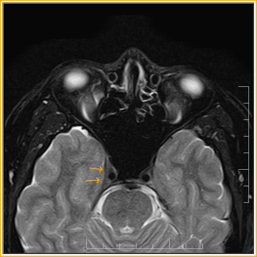 Tolosa-Hunt Syndrome-MRI - Sumer's Radiology Blog