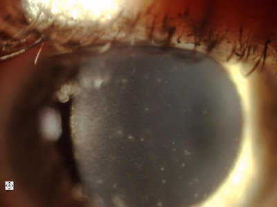 Sonoran Desert Eye Center: DIFFUSE CORNEAL SUBEPITHELIAL INFILTRATE