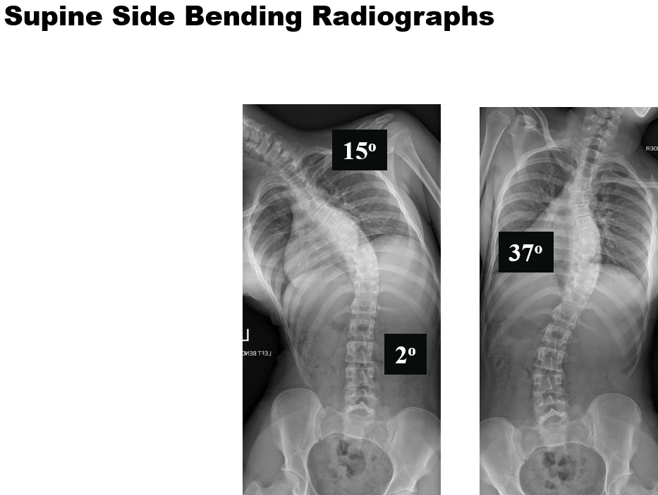 Spine Rotation in Scoliosis, Part 3 | Growing Spine Blog | Washington ...