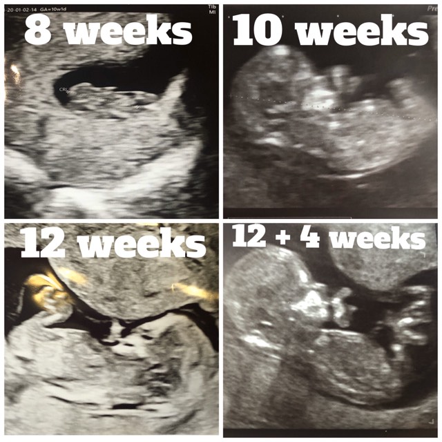Life Unexpected: 12 Weeks Pregnant - High NT Measurement
