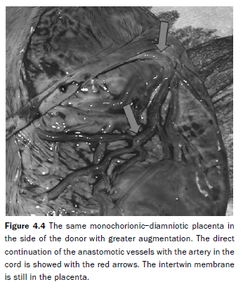 Placenta | Twin-Twin Transfusion Syndrome (TTTS)