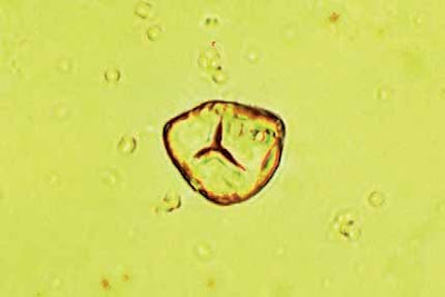 [Haematology] Microscopic Examination of Urinary Sediment - ARTIFACTS ...