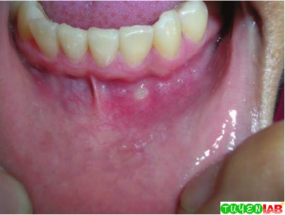 [Pediatric] Atlas of Aphthous ulcer | Free Medical Atlas