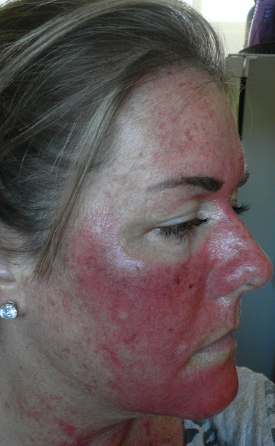 Efudex and Me 2013: Efudex Day Seventeen