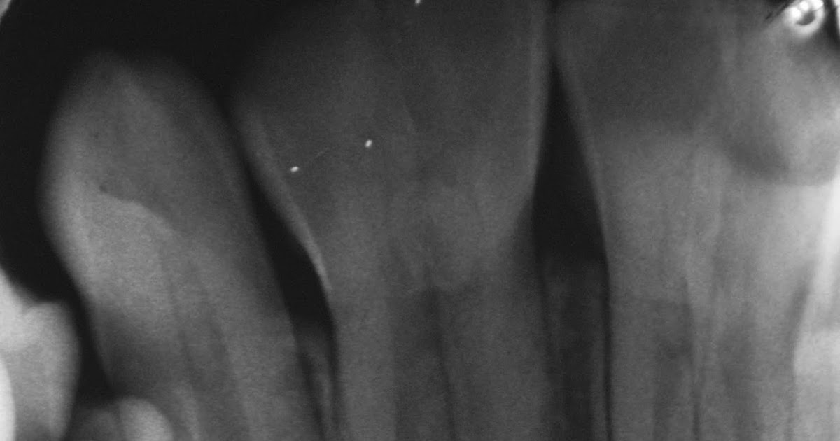 RADIOLOGÍA Mayhuasca PERÚ: ¿SE RELACIONA LA FUSIÓN DENTAL AL ODONTOMA?