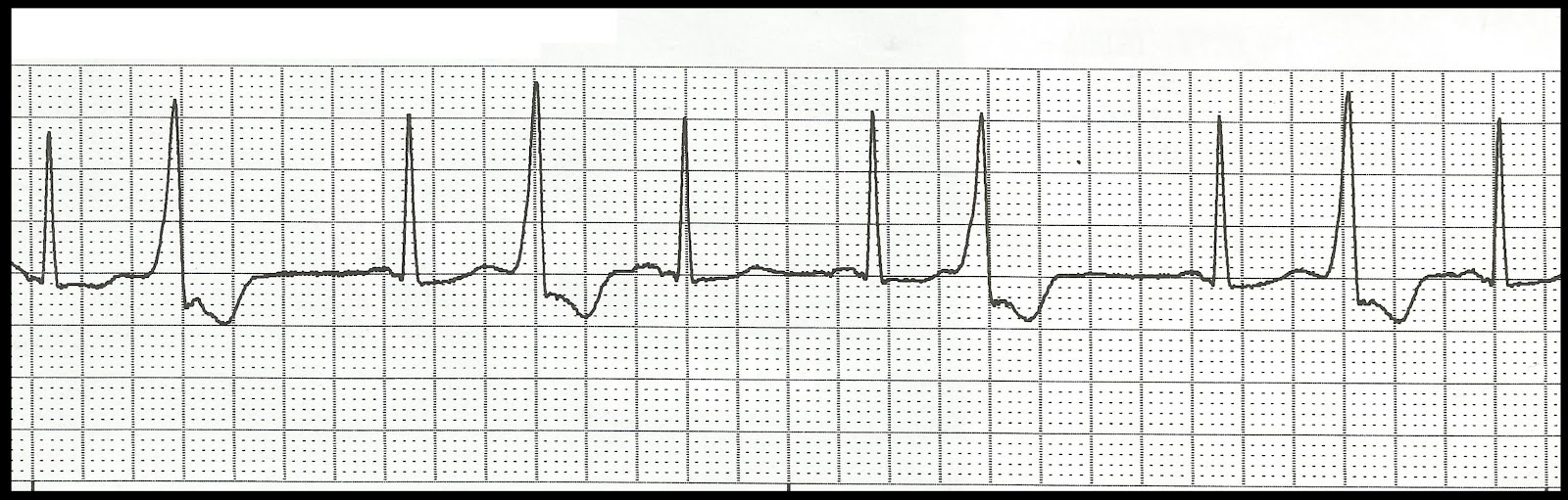 EKG Rhythm Strip Quiz 111