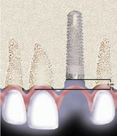Dentistry lectures for MFDS/MJDF/NBDE/ORE: Rationale Behind Axial ...