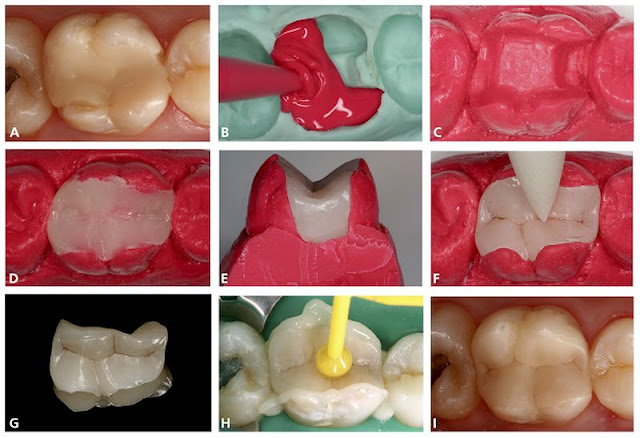 PDF: Semidirect posterior composite restorations with a flexible die ...