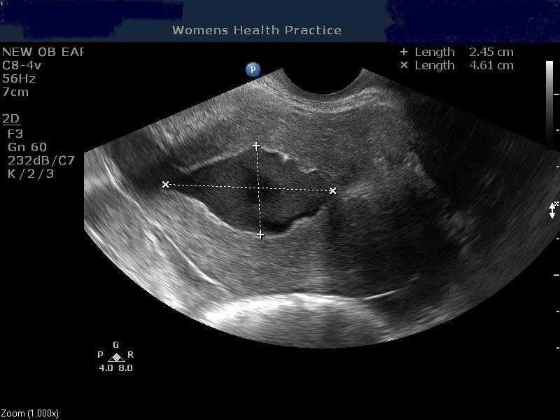 Hematometra Pictures: Blood Trapping By The Uterus