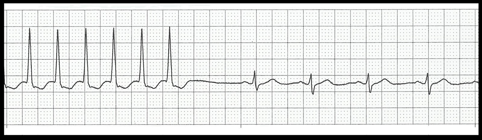 ECG Rhythm Strip Quiz 118