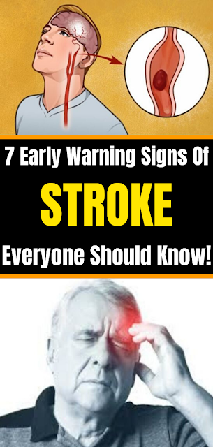 Here’s 7 Early Warning Signs Of Stroke Everyone Should Know ! | Only Tips