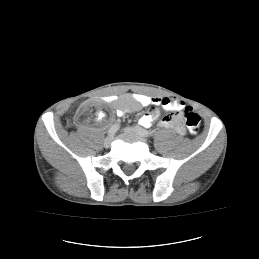Buckeye Surgeon: Colon Cancer Presenting as Intussusception
