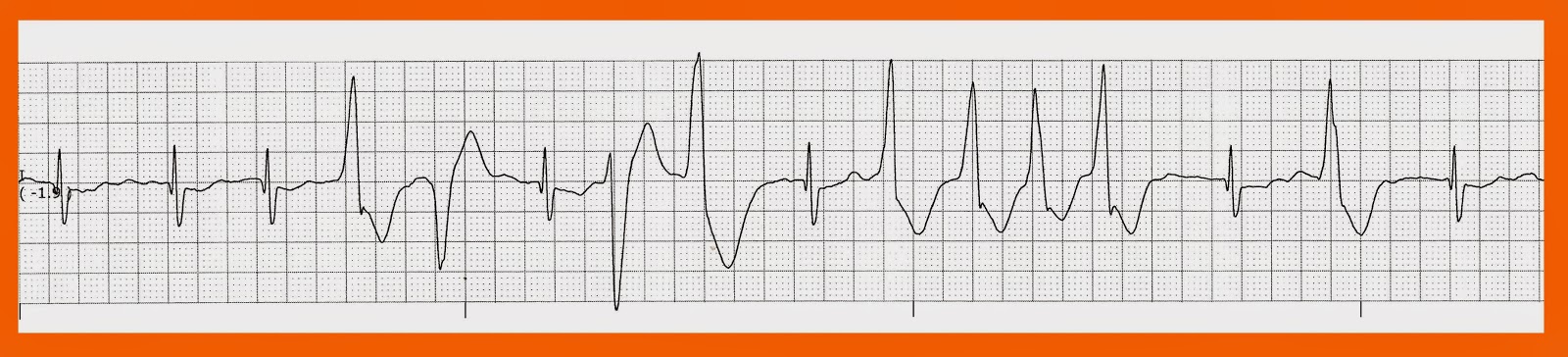 Practice EKG Strips 349