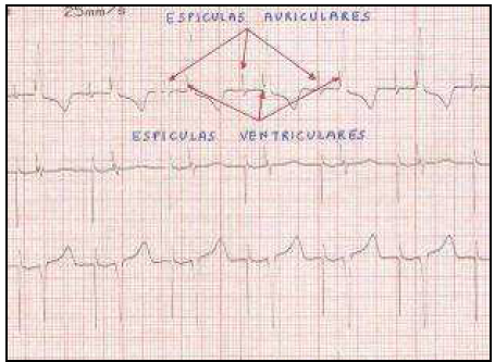 Enfermer@ en Urgencias y UCI : Manejo del Generador de Pulso de PM Temporal
