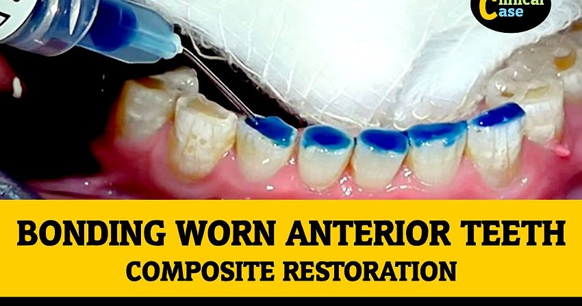 COMPOSITE RESTORATION: Bonding Worn Anterior Teeth - Dr Steven T ...