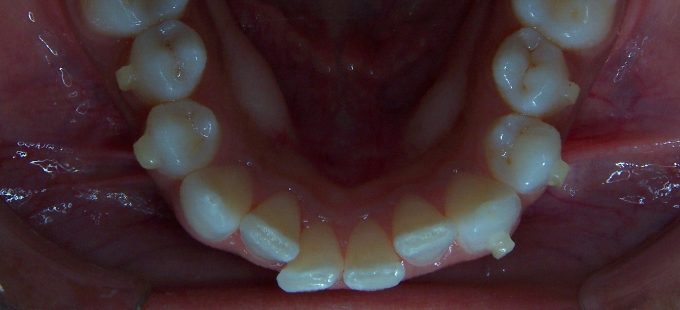 Toronto Invisalign - Brand New Smile :): Markham Invisalign Journey So ...