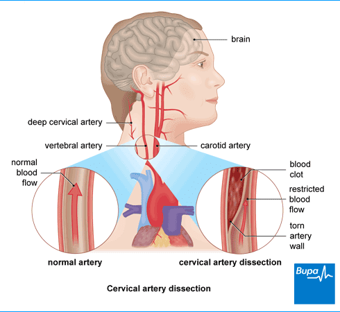 Carotid Artery Dissection - 3 Year Update - Purity Belle Blog