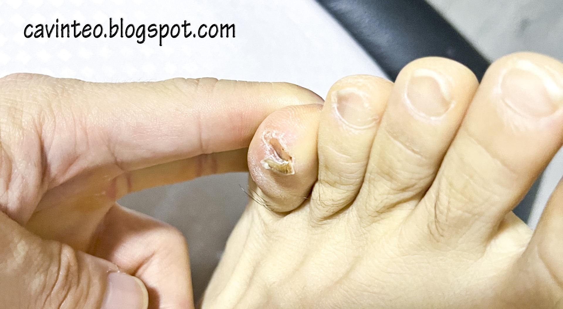 Entree Kibbles: Death of My Pinky Toenail