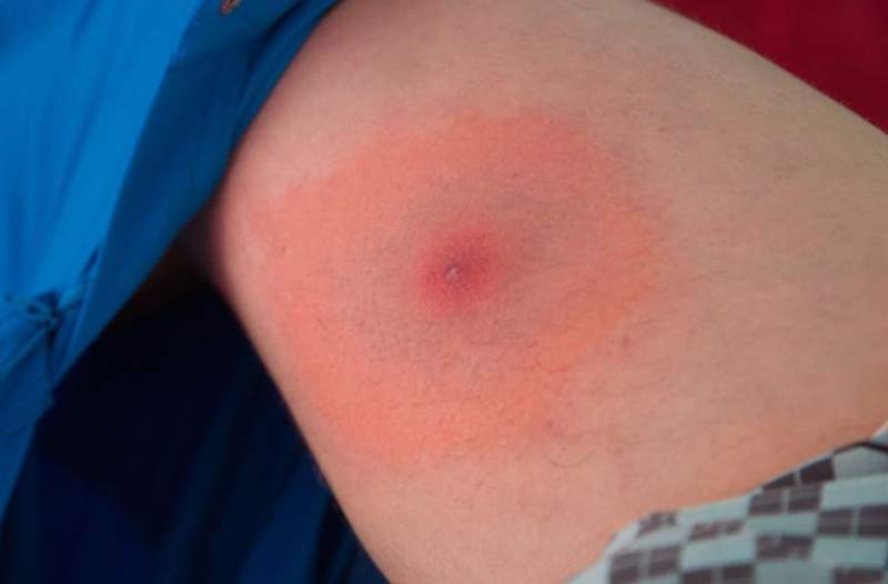 Muscatura de capusa si boala Lyme | Dr. Francu Nicoleta