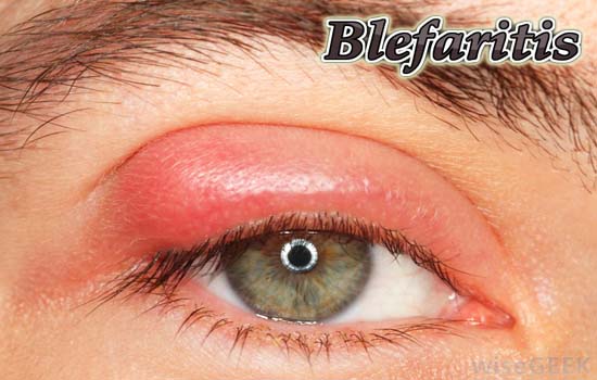 Obat Blefaritis Paling Ampuh ~ Harga Walatra Sehat Mata Di Apotik