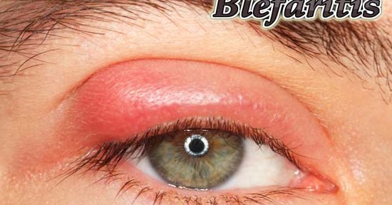 Obat Blefaritis Paling Ampuh ~ Harga Walatra Sehat Mata Di Apotik